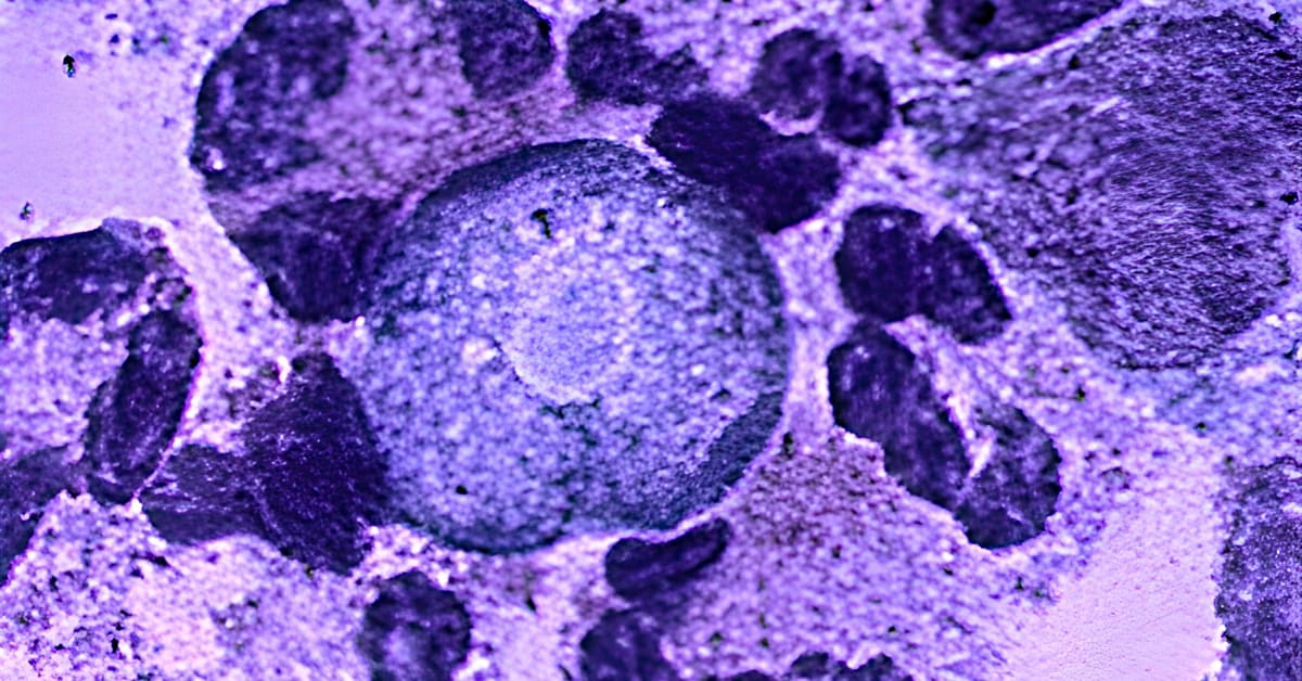 This Rare Infection Has a 98 Percent Fatality Rate. And It’s Linked to ...