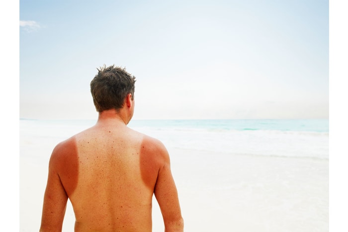 How To Prevent Treat And Heal Sunburned Skin This Summer Mens Journal
