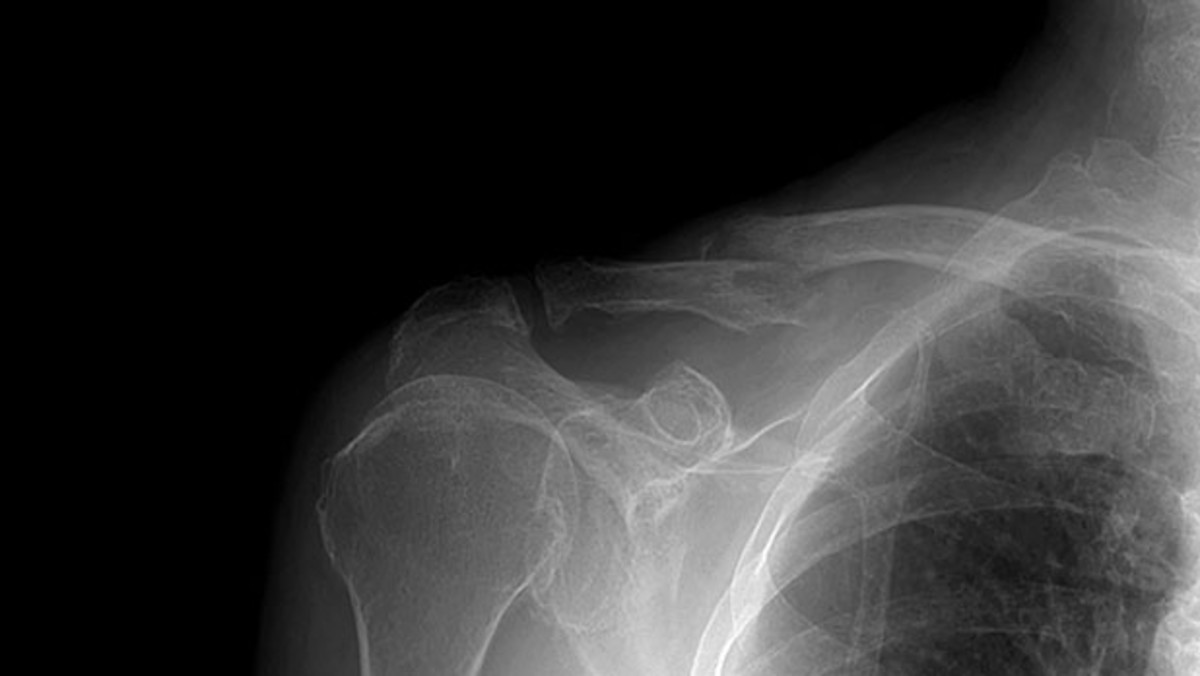 Top 10 Causes and Treatments for Shoulder Pain - Men's Journal