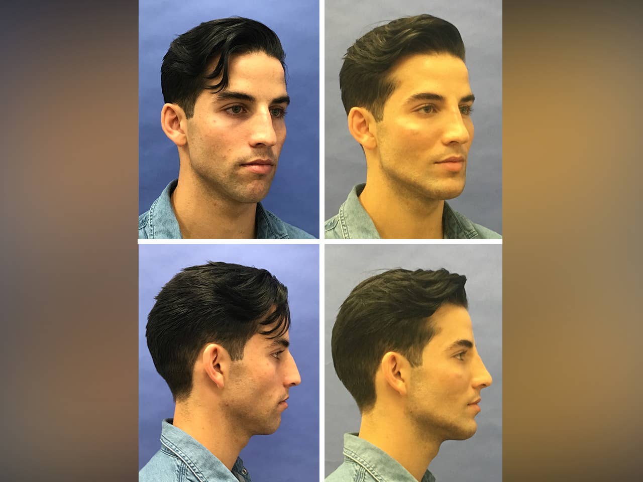 Plastic Surgeries Guys Are Getting to Look More Manly - Men's Journal